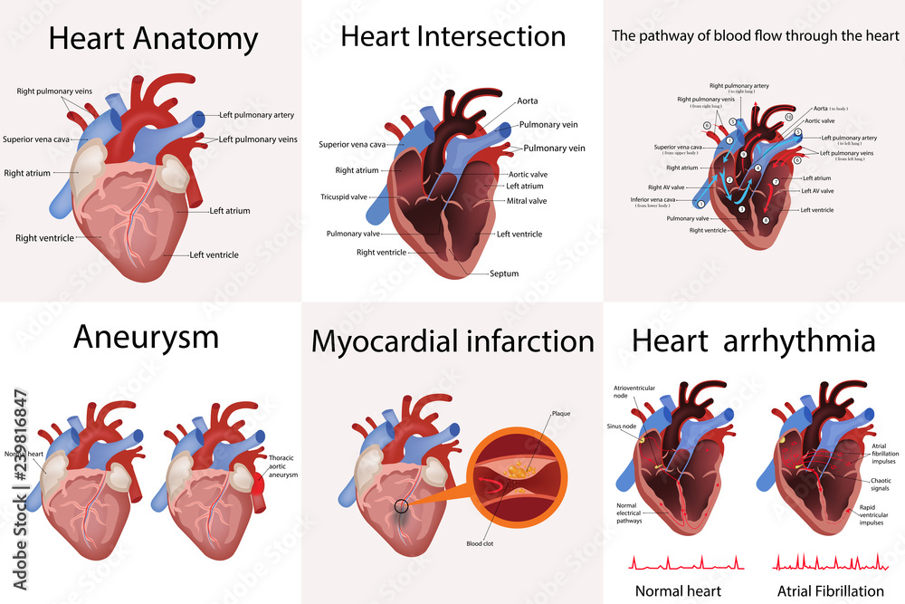 Heart Anatomy And Types Of Heart Disease Vector Illustration Stock Vector Adobe Stock