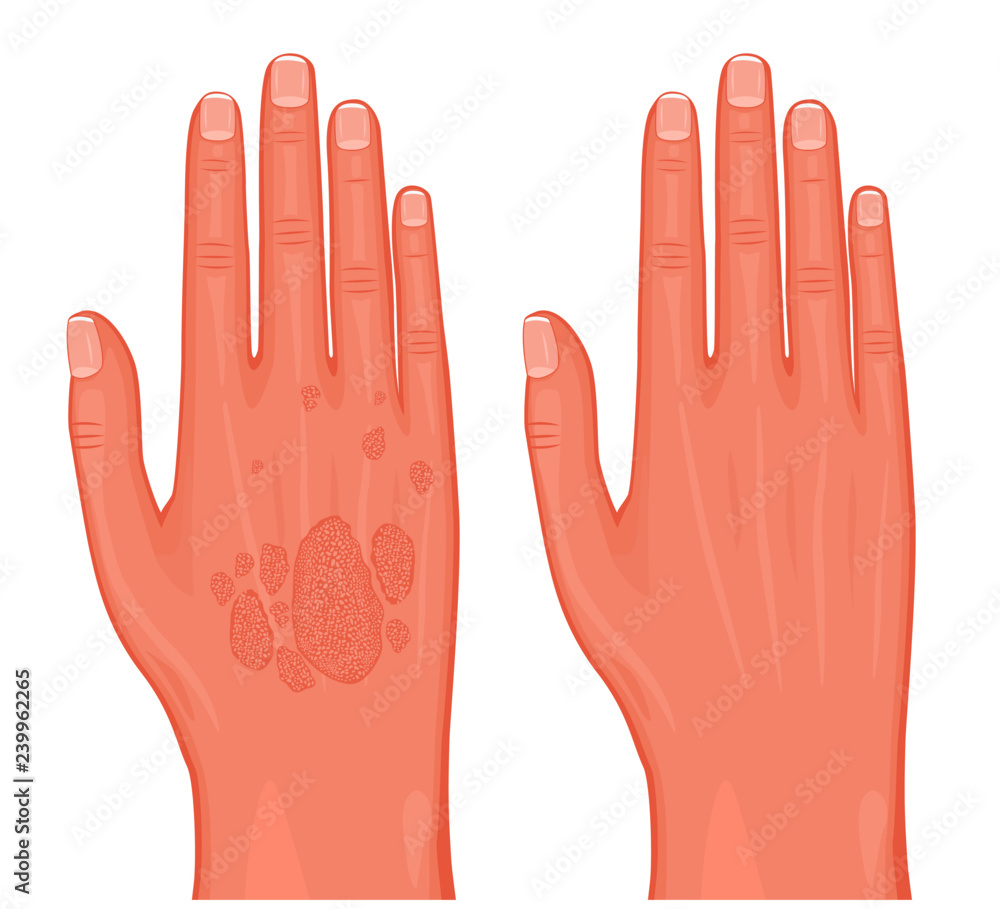 Vector illustration. Psoriasis on the skin of the hands before and ...