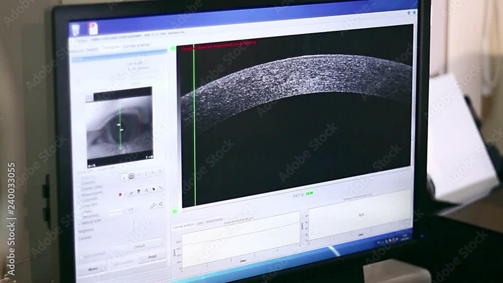 corneal wavefront analysis, Scanning the retina, Unrecognizable young ...