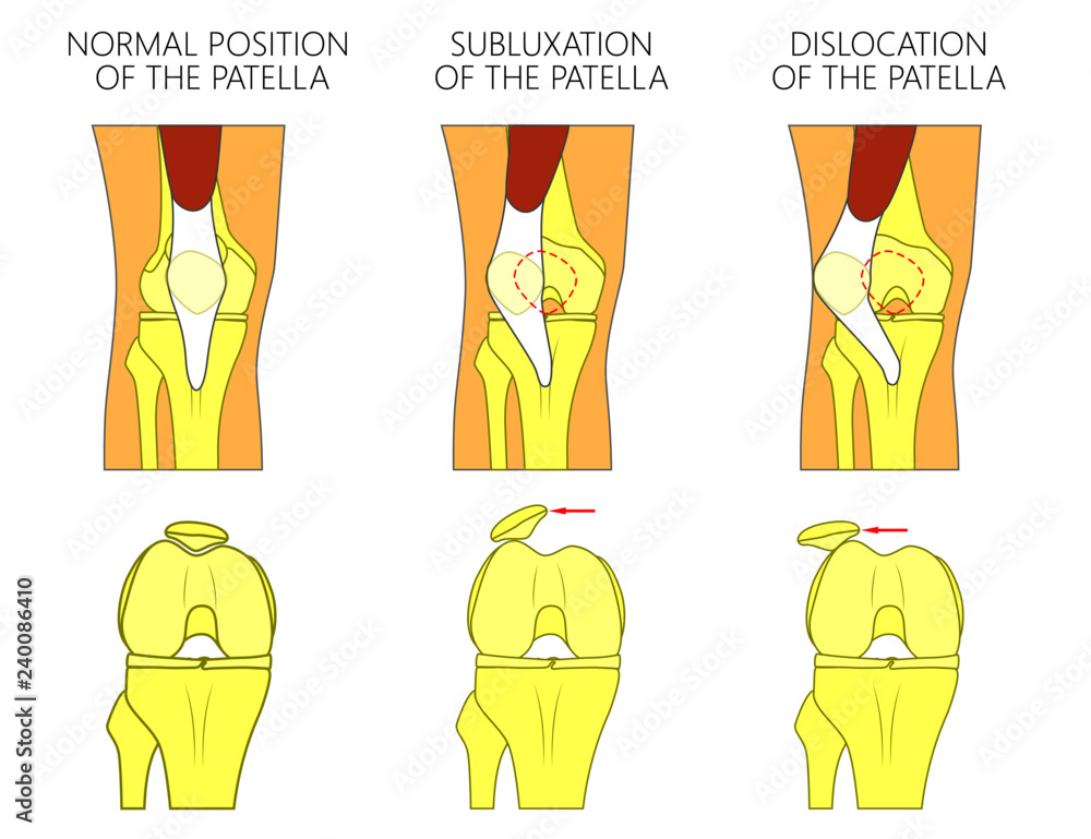 Vector illustration of a healthy human knee joint and unhealthy knees ...