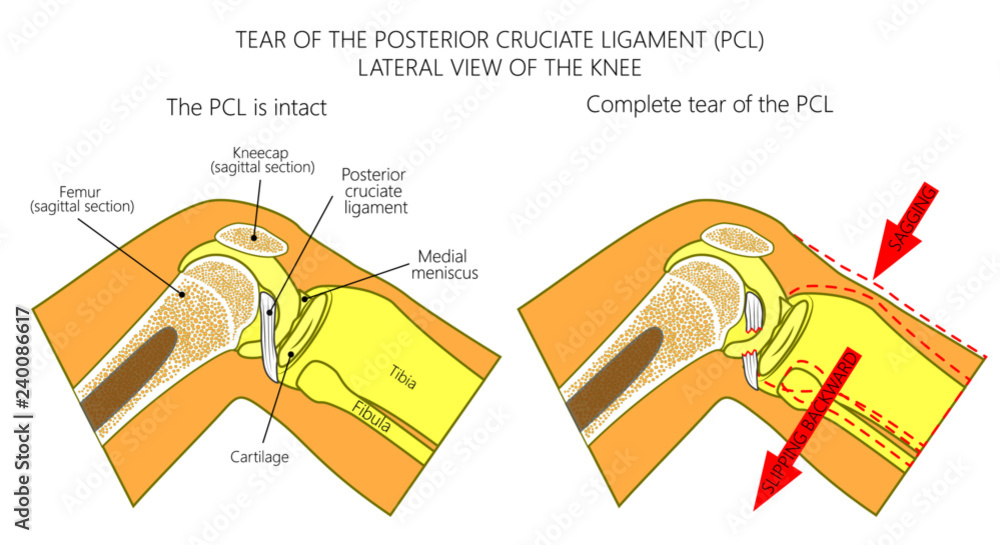 Vector illustration anatomy of a knee joint with healthy and torn ...