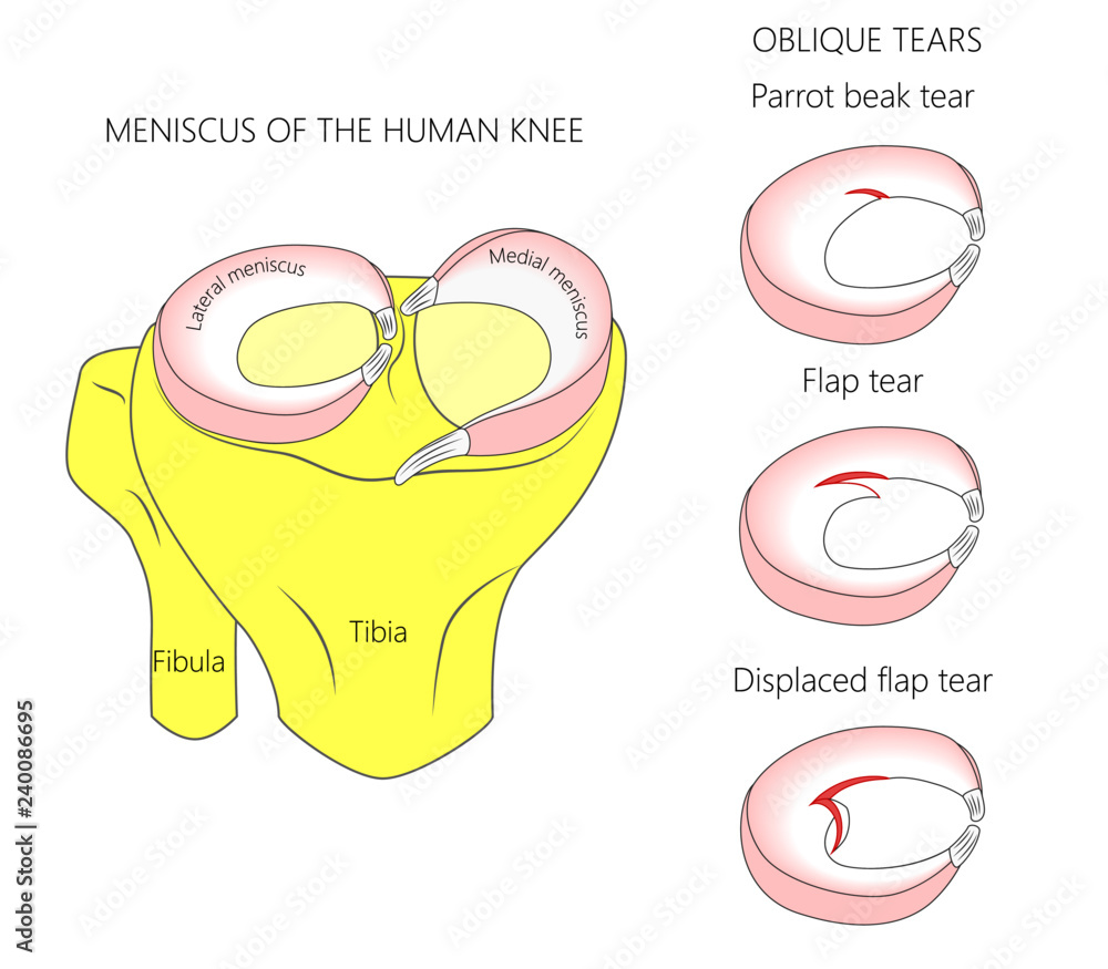 Vector illustration. Anatomy of a meniscus in the healthy human knee ...