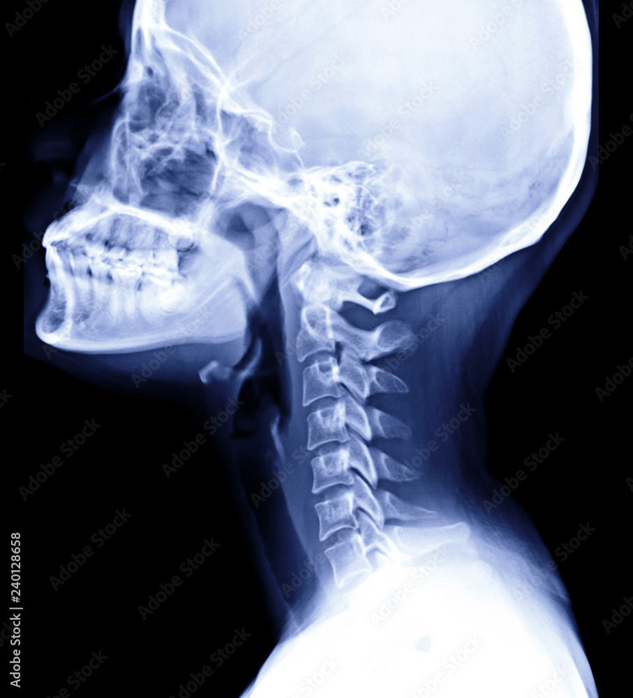 Photo & Art Print x-ray image of cervical spine or neck Lateral view or ...
