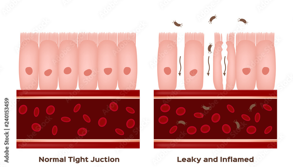 Celiac disease Small intestine lining damage. good and damaged villi ...