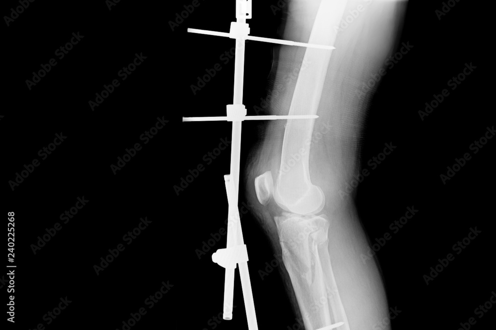 Show fracture tibia and fibula left lateral. X-ray image of fracture ...