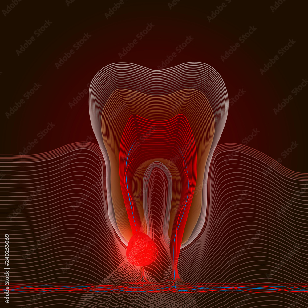 Linear stylization of dental disease with a point of pain and ...