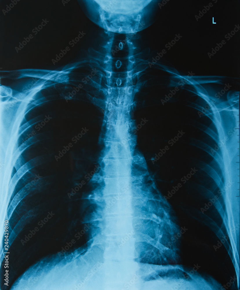 X-ray of a thorax, close-up. X-Ray film of human skeletal system Stock ...