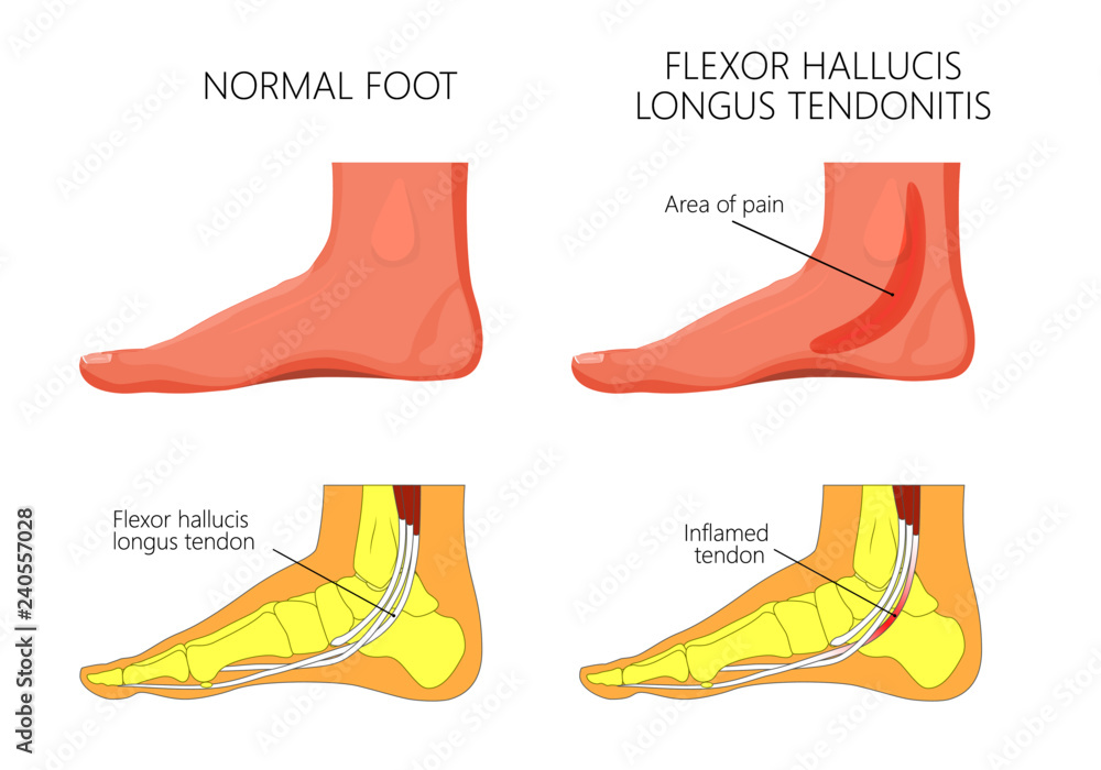 Medial Foot Tendons