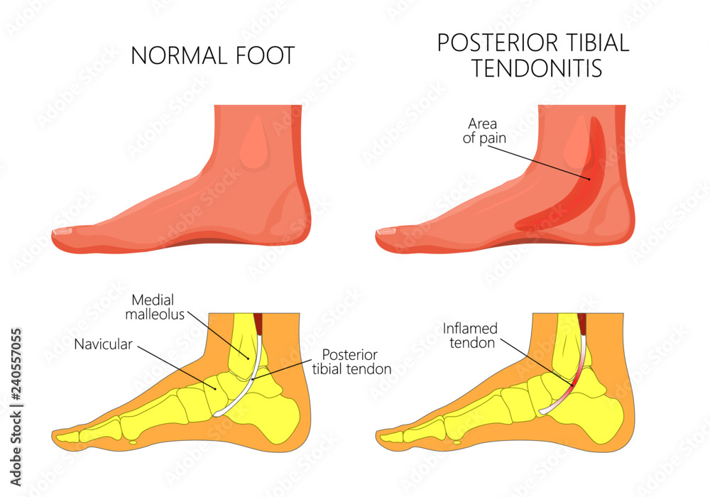Vector illustration of healthy human foot and a medial ankle injury ...