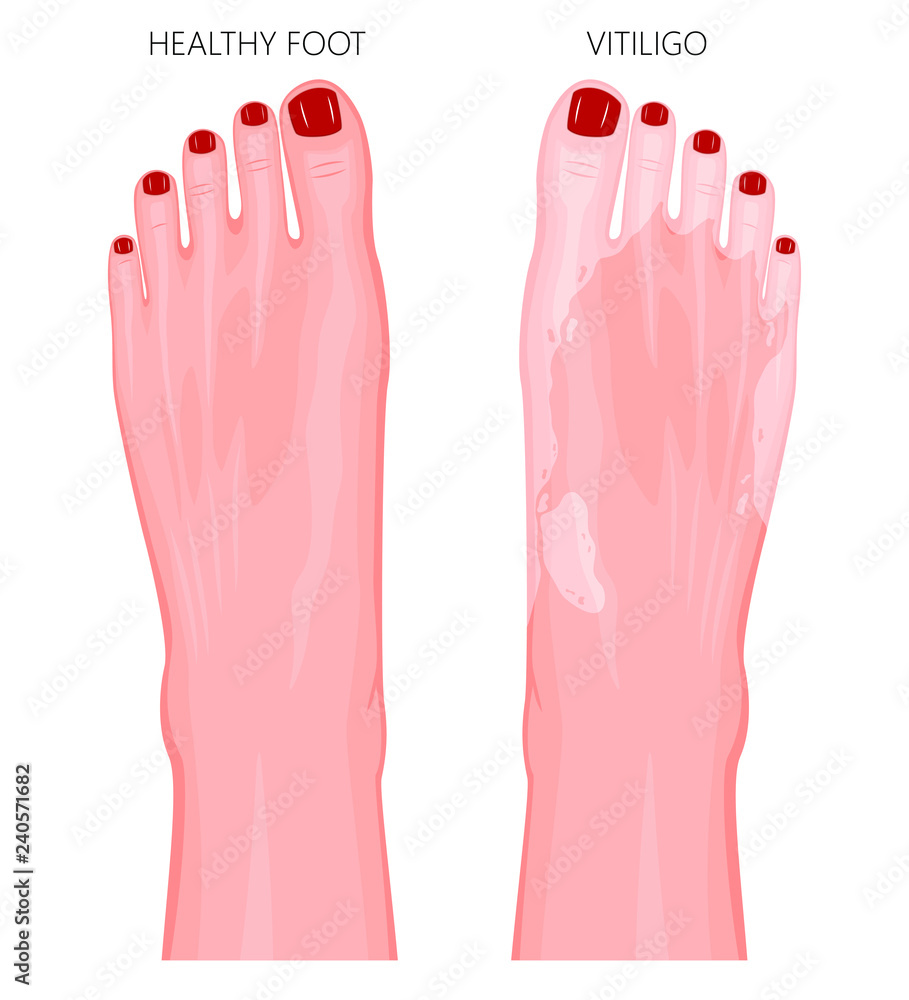 Vector illustration of a healthy foot with red toenails and a foot with ...