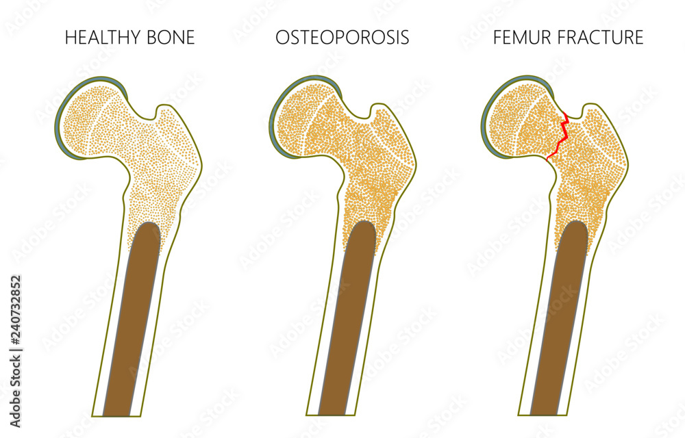 Vector illustration of a healthy human thigh bone, osteoporosis of ...