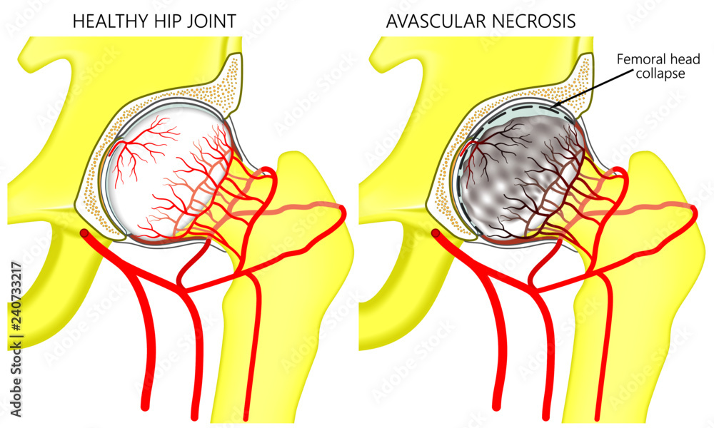 Vetor de Vector illustration anatomy of a healthy human hip joint and a ...