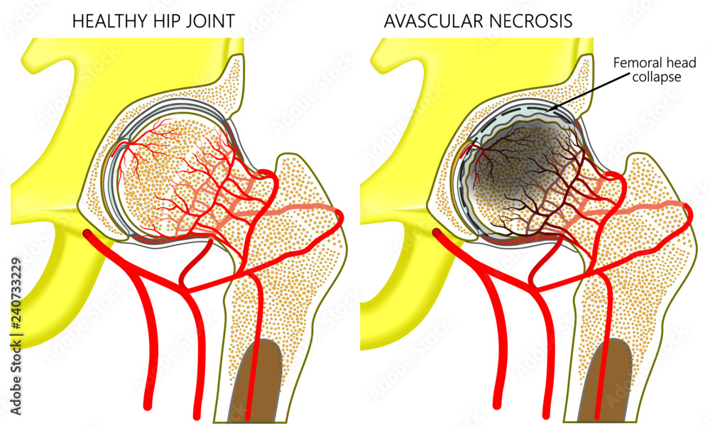 Collapsed Femoral Head
