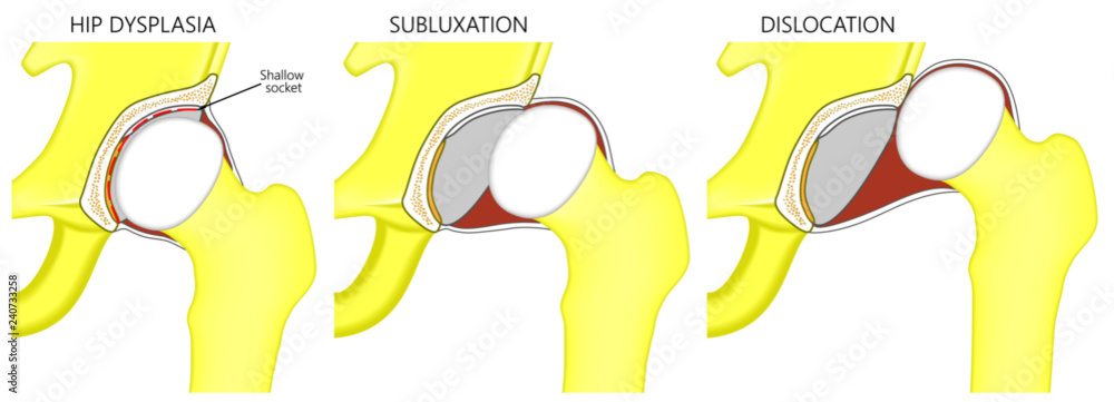 Vector illustration anatomy of a hip joint with dysplasia, subluxation ...