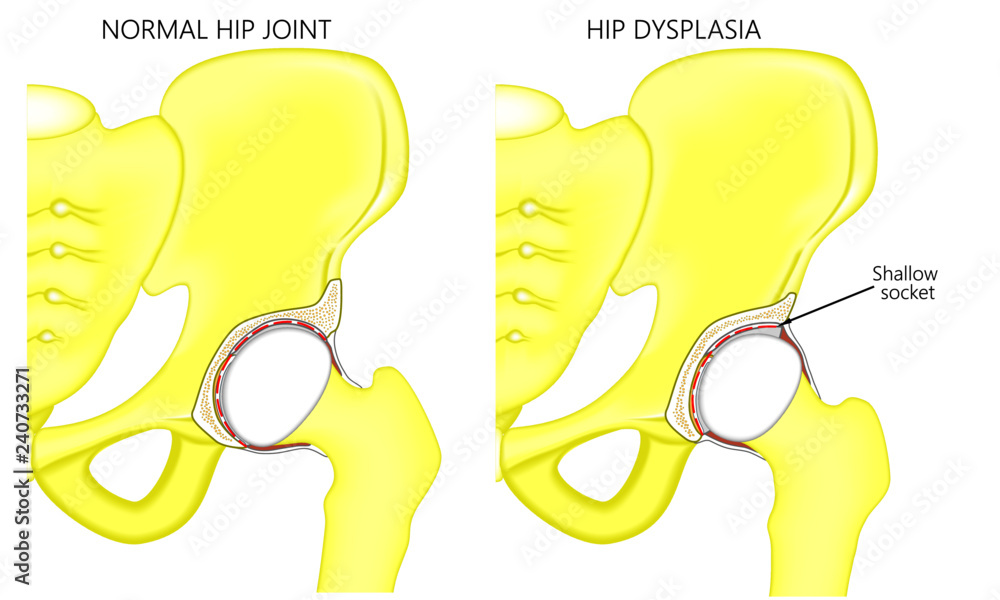 Vector illustration anatomy of a healthy human hip joint and hip with ...