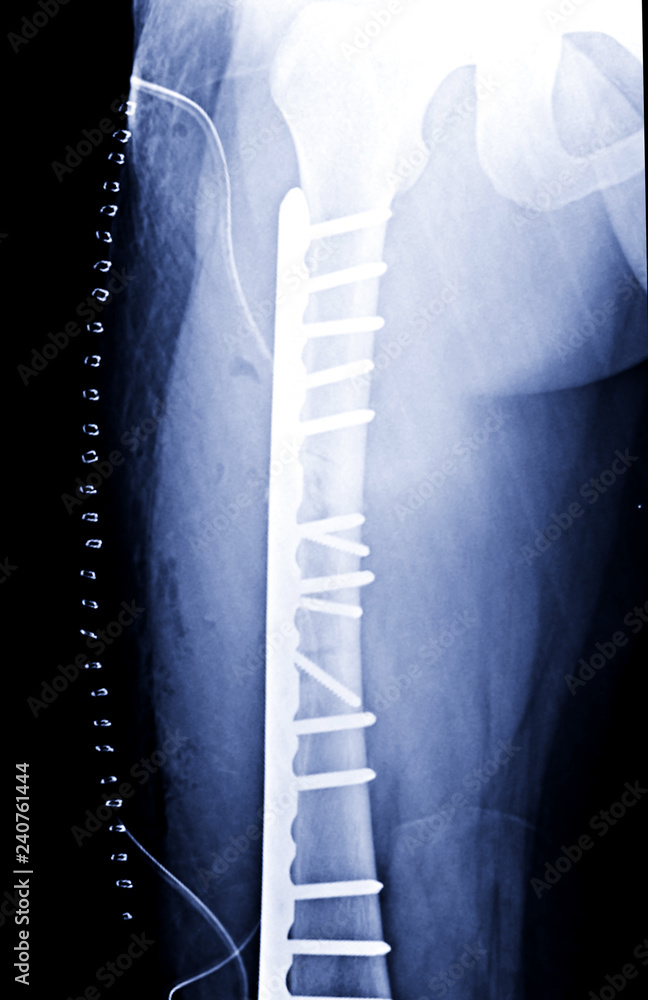 Femoral Shaft Fractures post fix with plate and screws. femur fracture ...