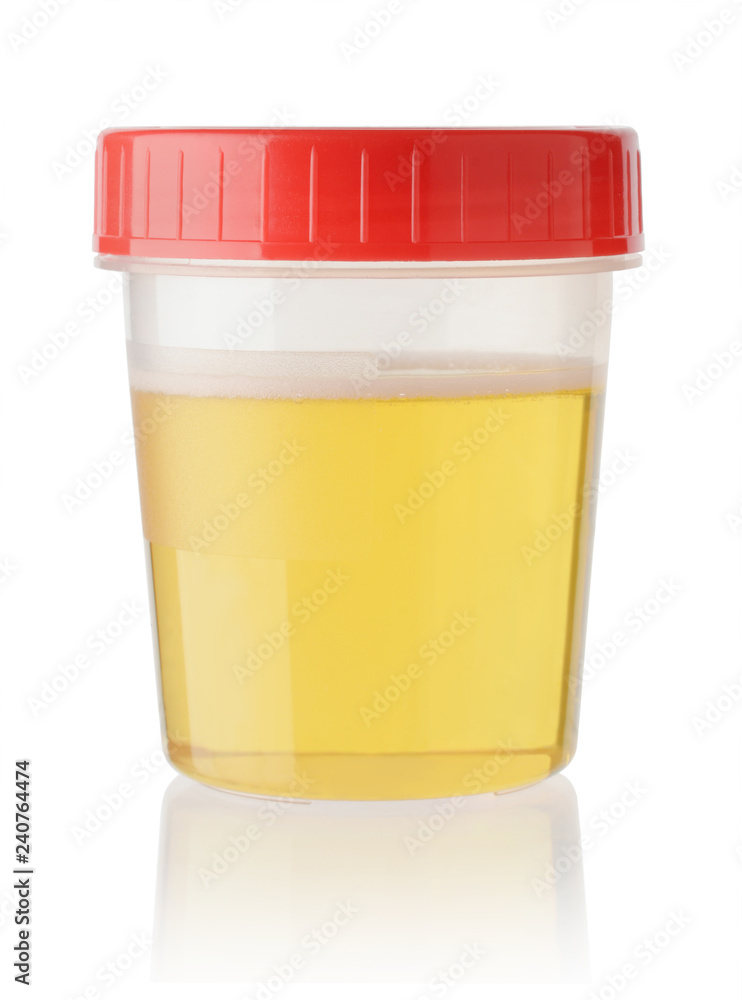 Urine sample in container isolated on white Stock Photo | Adobe Stock