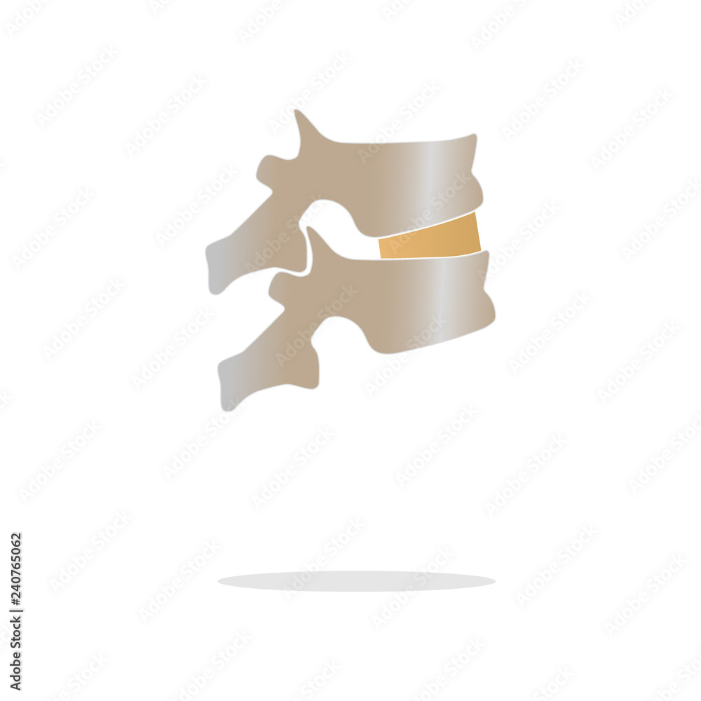 Ankylosing Spondylitis Realistic Vector Medical Chart with Human ...