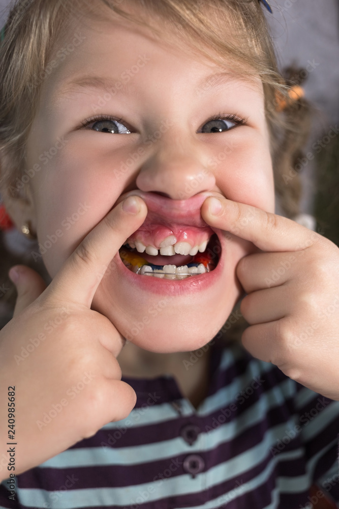 Adult permanent teeth coming in front of the child's baby teeth: shark ...