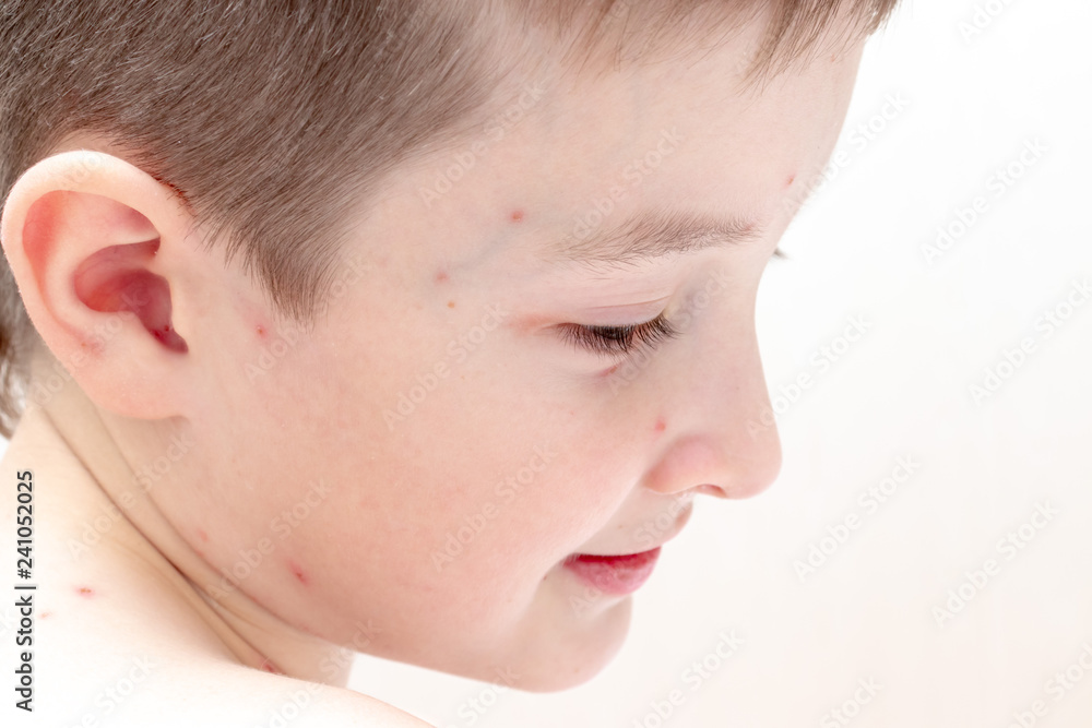 Face of caucasian boy with Varicella virus or Chickenpox, child with ...