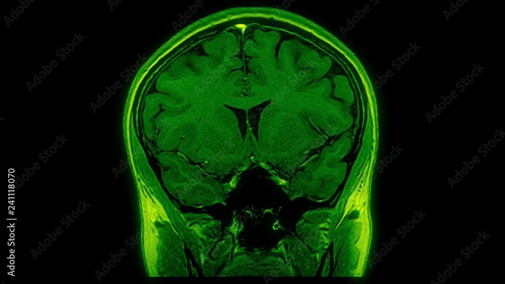 Computed medical tomography MRI upscaled scan of healthy young female ...