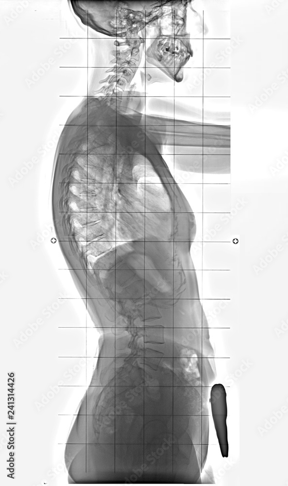 X-ray of human body, from chest to pelvis, complete spinal, kyphosis ...