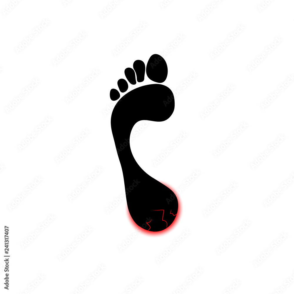 Symbol of Human foot with painful red cracks on heel. Vector object ...