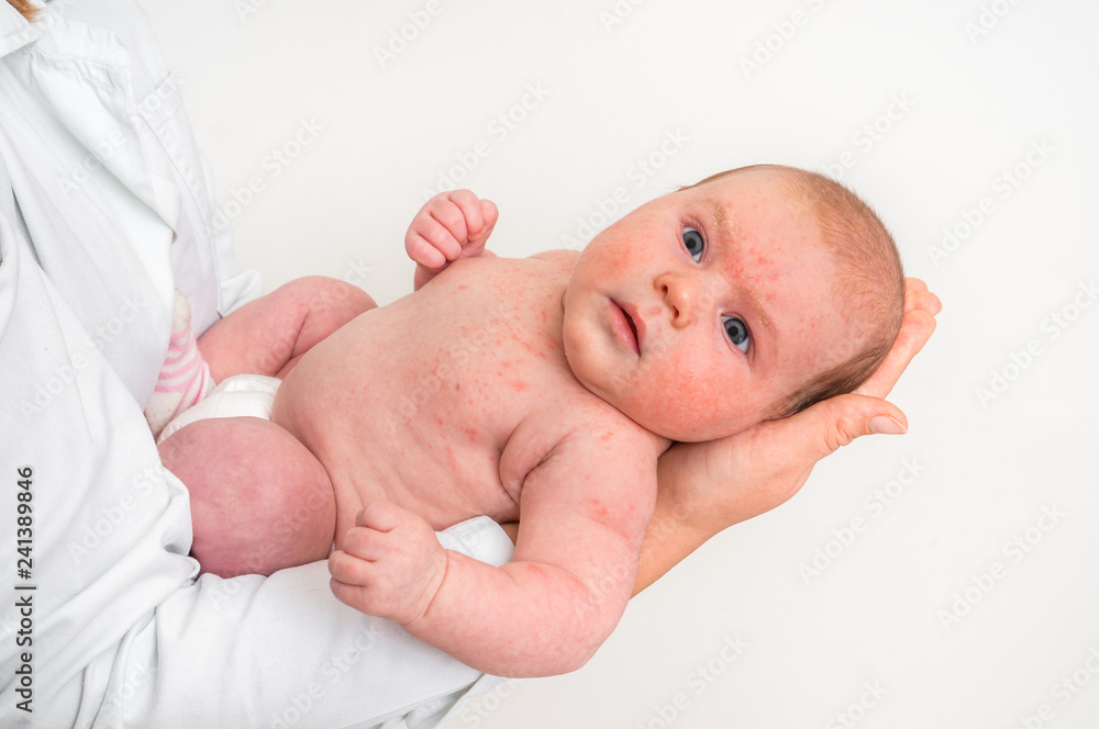 Newborn baby with skin rash. Allergic reaction after birth. Stock Photo ...