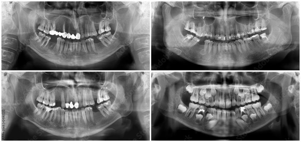 Panoramic dental x-ray digital image of upper and lower jaw. Radiograph ...
