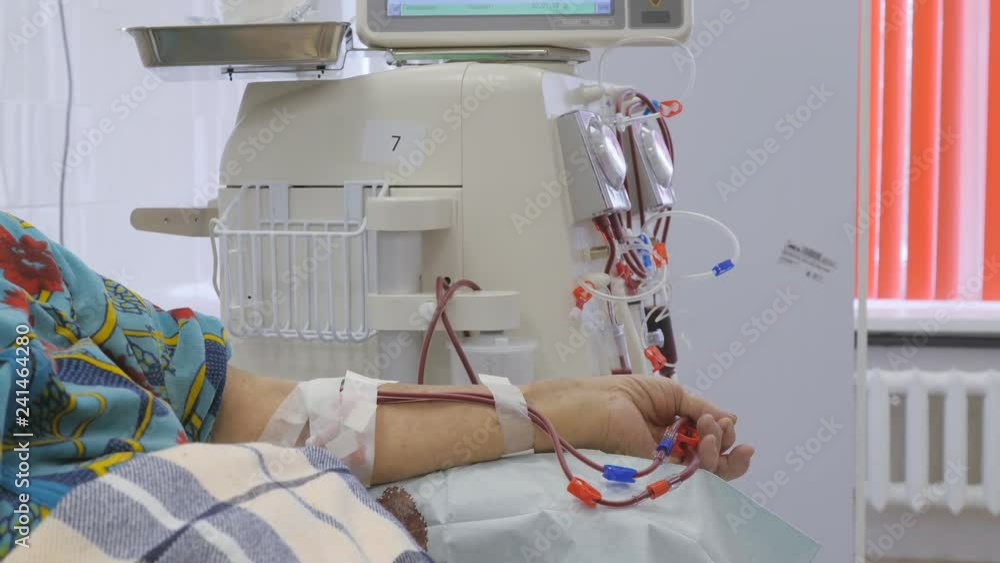 Hemodialysis. Machine artificial kidney. The hand of the patient is ...