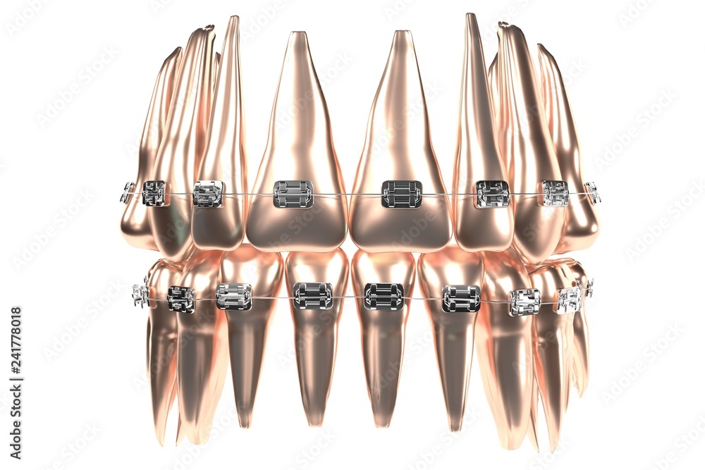 Dental golden teeth model with braces, on white background. Photo ...