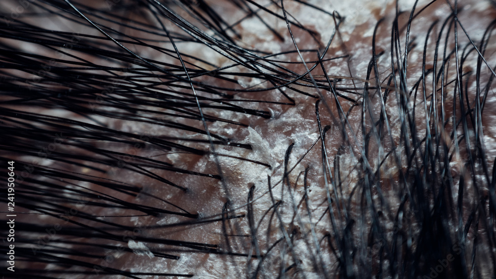 Hair scalp with dandruff and scaly from psoriasis Stock Photo | Adobe Stock