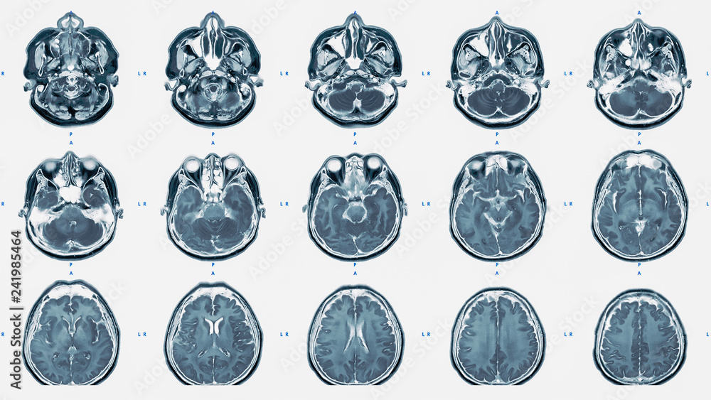 magnetic resonance image (MRI) of the brain Stock Photo | Adobe Stock