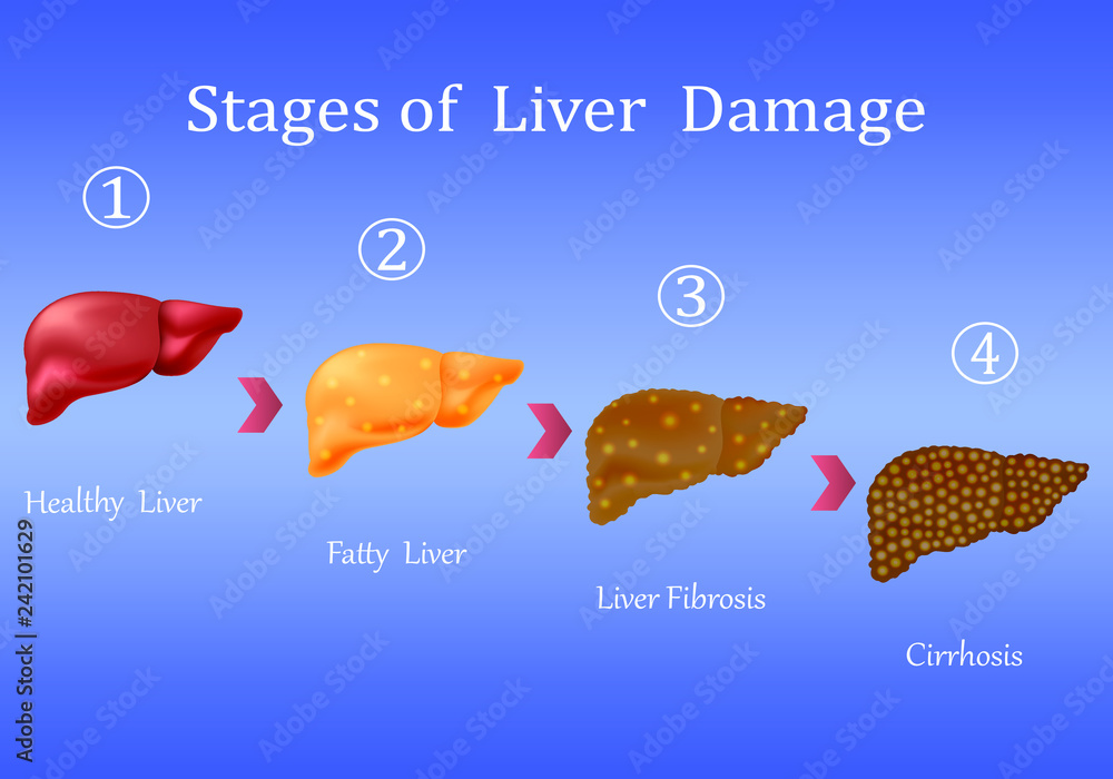 Stages of liver damage, liver disease. Healthy, fatty, liver fibrosis ...