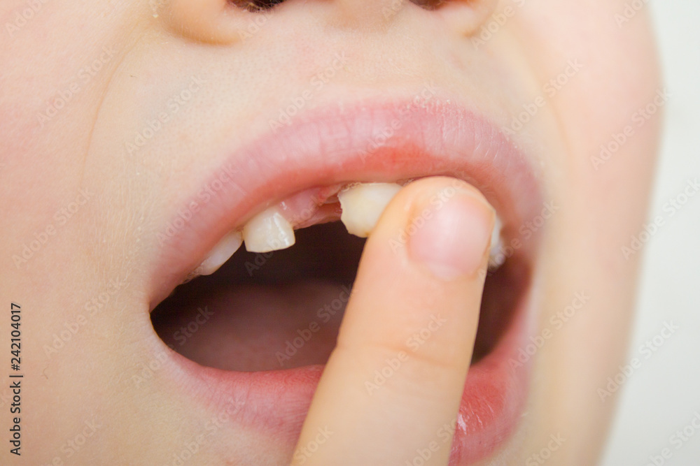 The baby girl smiling and shaking wobbly milk tooth in open mouth with ...