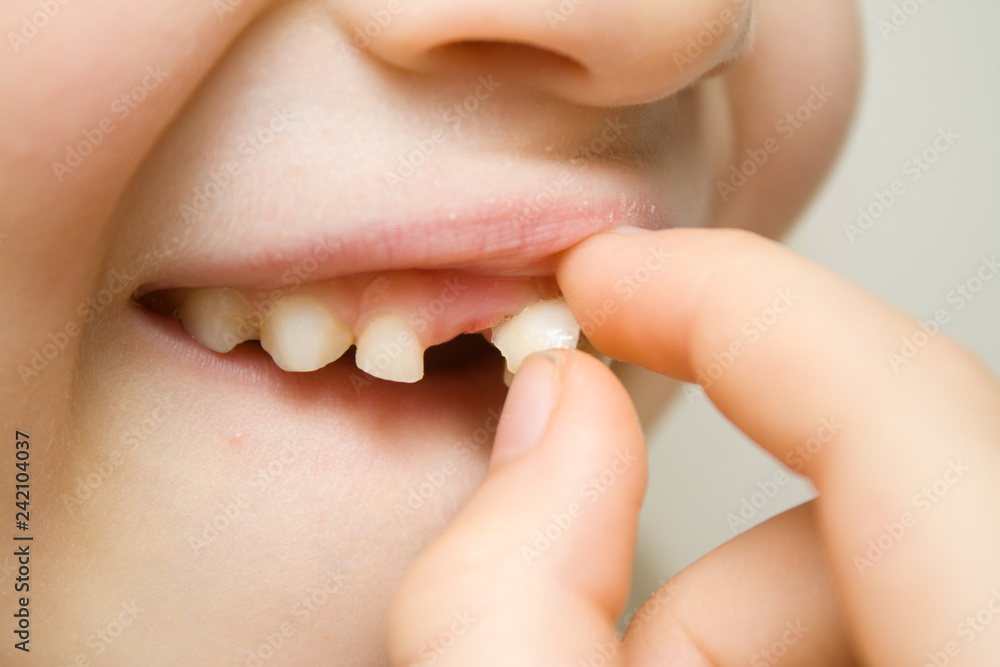 The baby girl smiling and shaking wobbly milk tooth in open mouth with ...