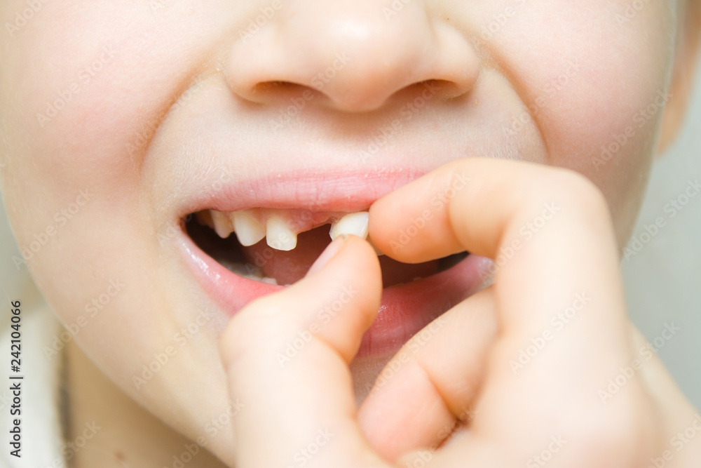 The baby girl smiling and shaking wobbly milk tooth in open mouth with ...