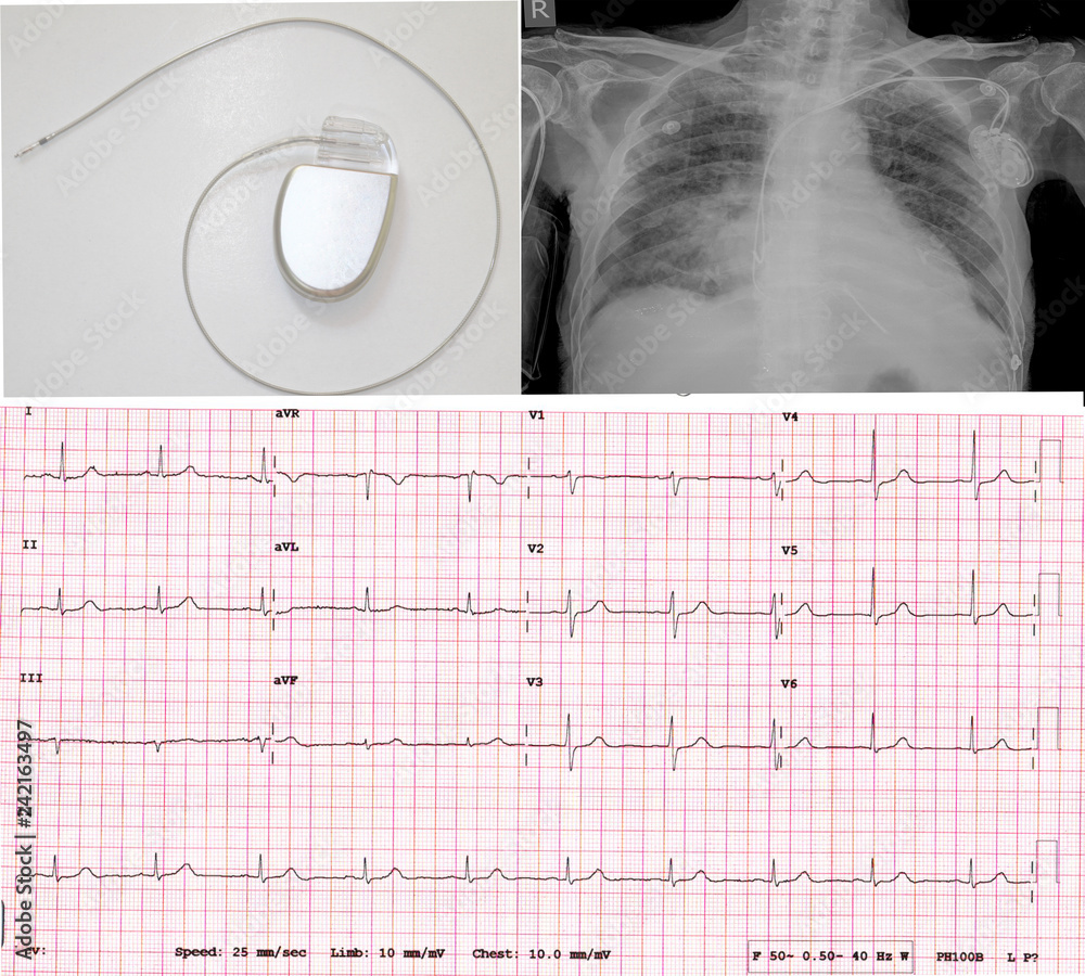Electrocardiogram of wave in paper report with pacemaker and chest x ...