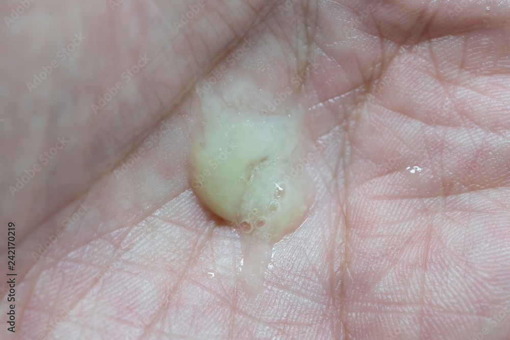 Green mucus on a man hand Stock Photo | Adobe Stock