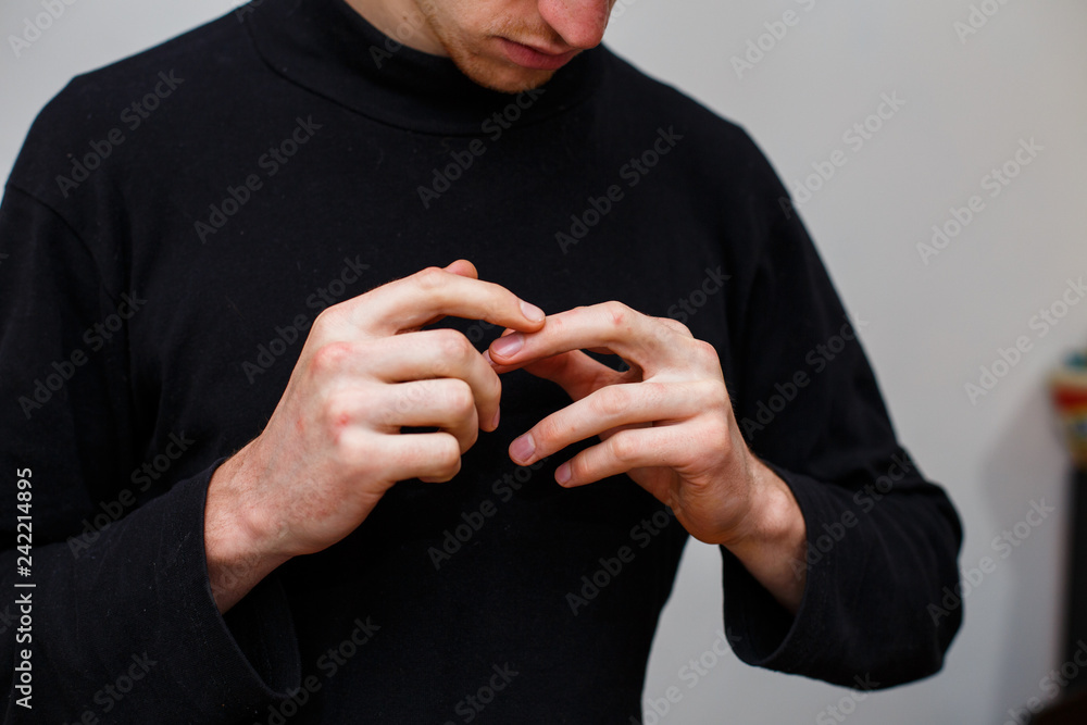 Psoriatic nail disease and skin plaques on hands of a patient with ...