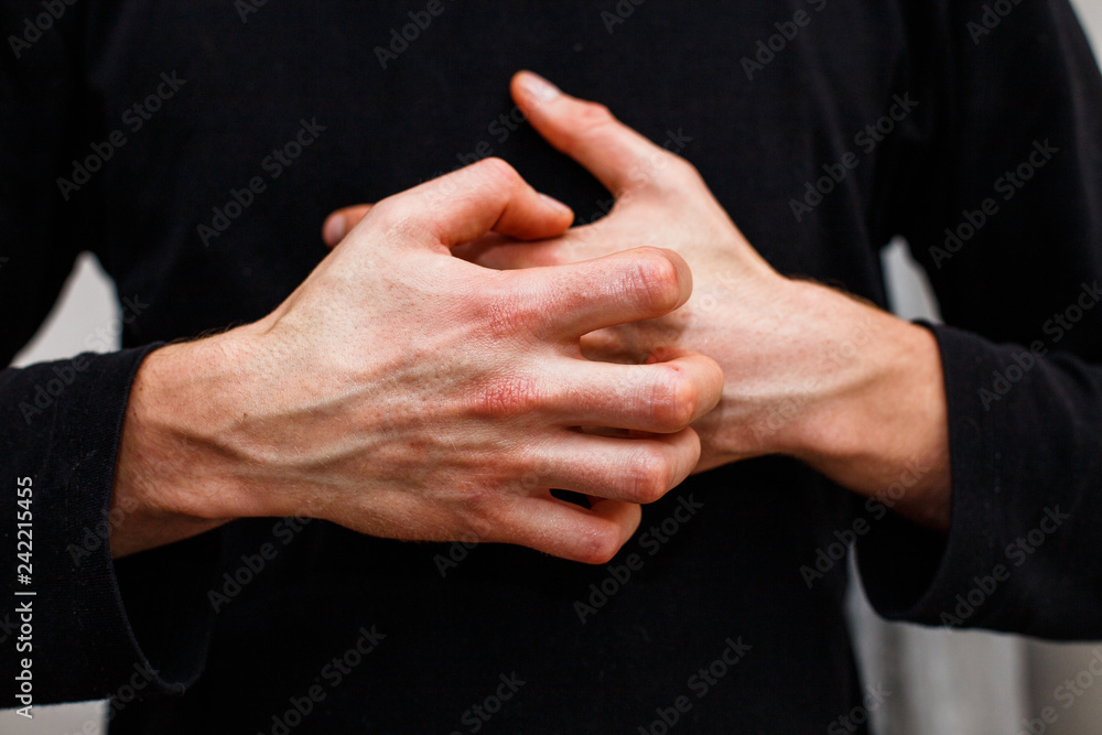 Man scratch oneself, dry flaky skin on hand with psoriasis vulgaris ...