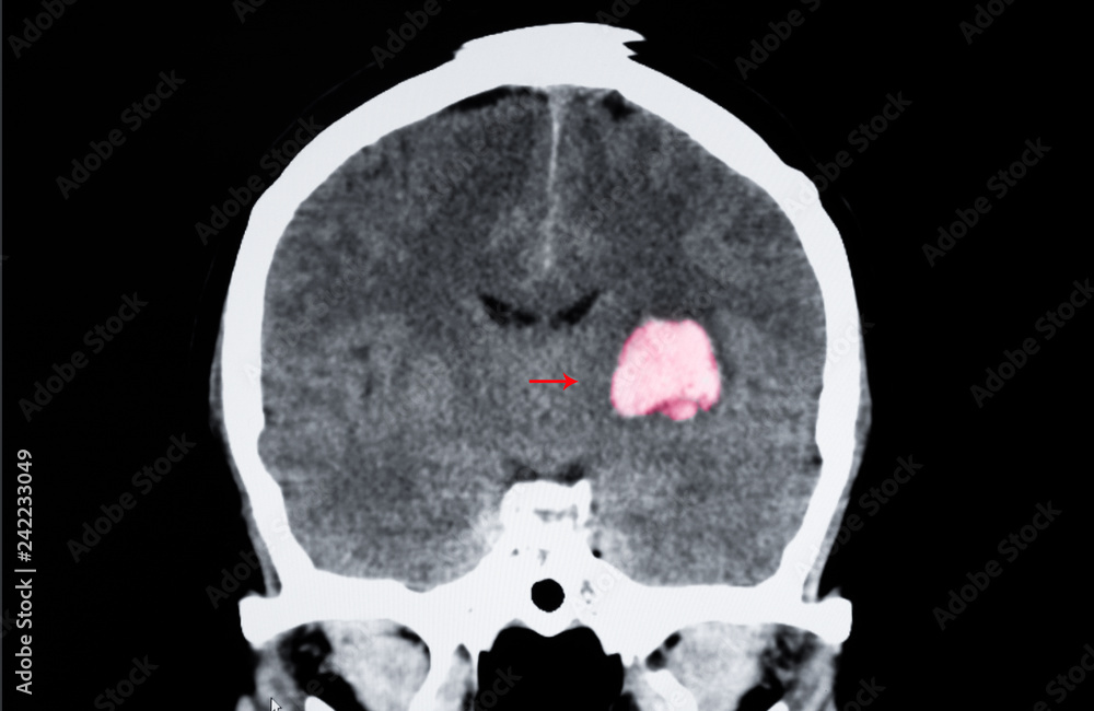 CT scan of the brain of a stroke patient Stock Photo | Adobe Stock