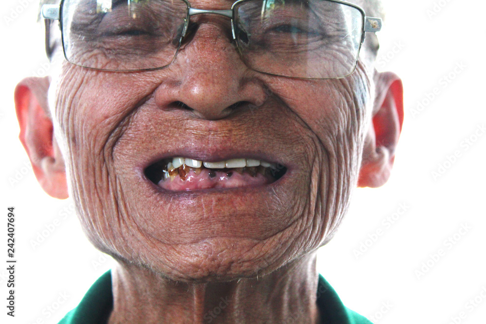 Elderly Asian man showing severe teeth decay causing foul smell, black ...