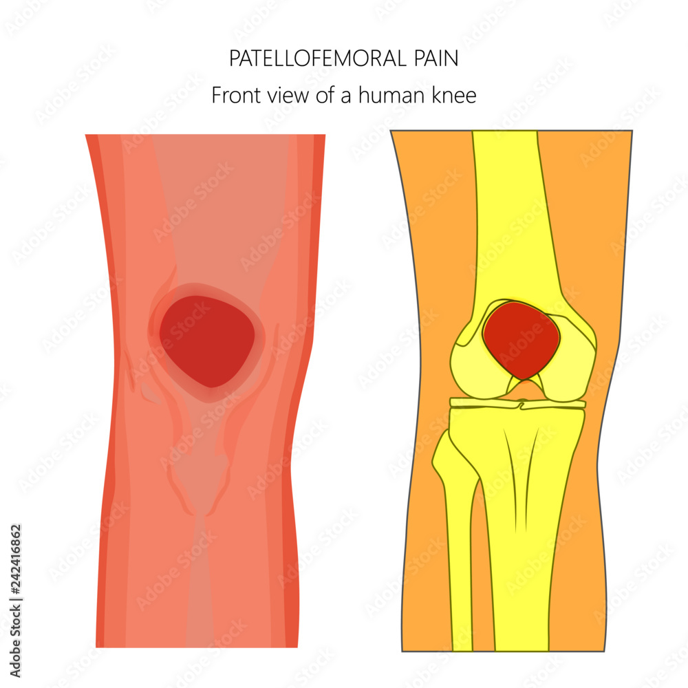 Vector illustration of unhealthy human knee joint with patellofemoral ...
