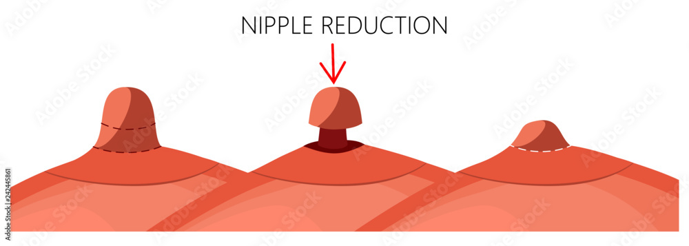 Vettoriale Stock Vector Illustration Of The Long Nipple Reduction