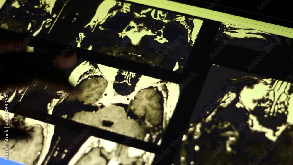 Analyzing of Spinal cord image on touch screen display. Doctor and MRI ...