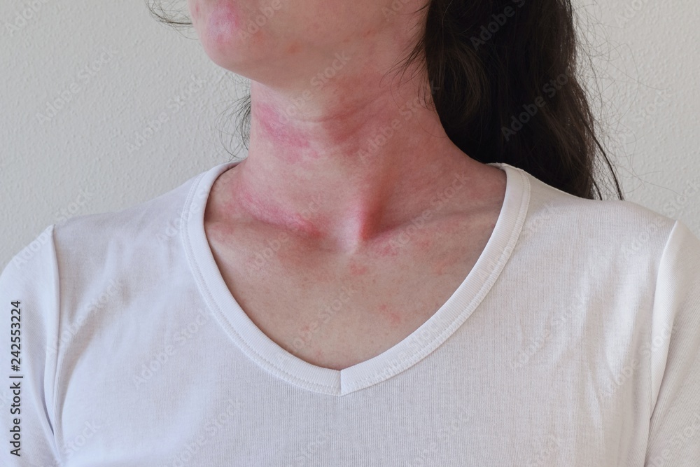 Allergic skin reaction on the female neck and face Stock Photo | Adobe ...