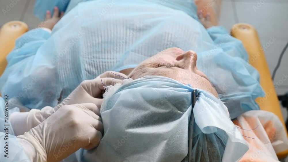 Beauty surgical operation to hide signs of aging. Flaccid face skin ...