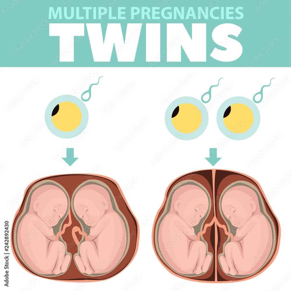 Variants of cell division under twins. Infographics. Detailed vector ...