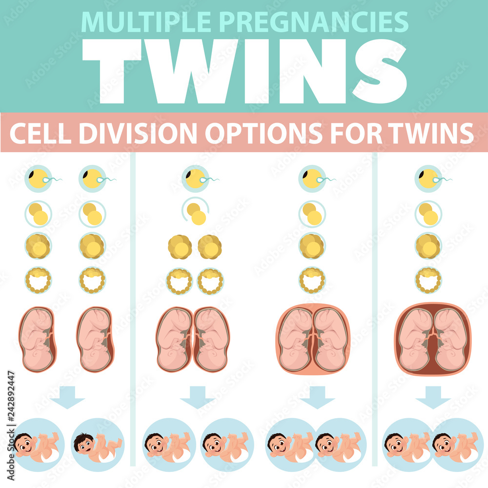 Variants of cell division under twins. Infographics. Detailed vector ...